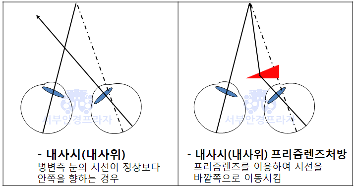 서부안경프라자 내사시이야기 ① 내사위와 간헐내사시 원인과 증상 및 치료방법 네이버 블로그