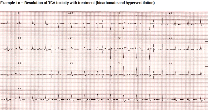 Tca Overdose Ecg 네이버 블로그
