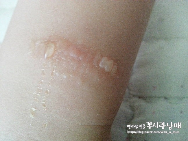 모기물린데 물집 관리방법 알려드려요 네이버 블로그