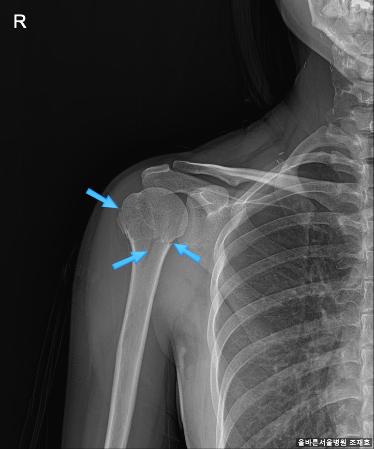 상완골 분쇄 골절에서의 Mipo 수술mipo Technique At Proximal Humerus Comminuted