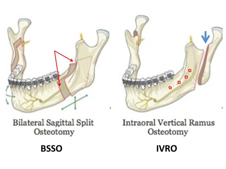 최초의 양악수술 : 네이버 블로그