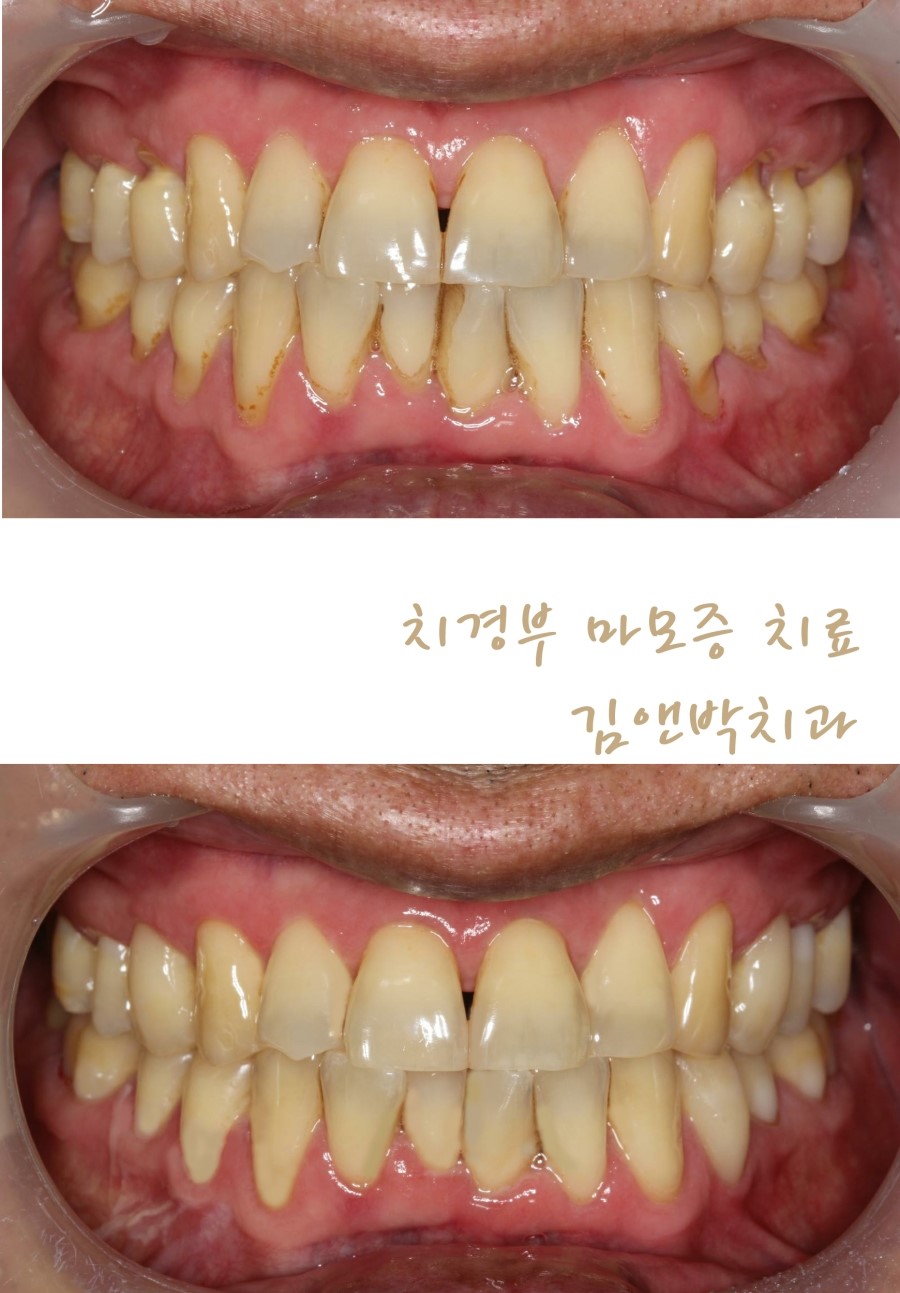 치경부 마모증 Cerec Cervical 레진치료 남포동치과 시린이치료 김앤박치과 네이버 블로그