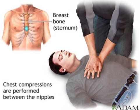 심폐소생술 (CPR, cardiopulmonary resuscitation)의 순서와 시행방법 : 네이버 블로그