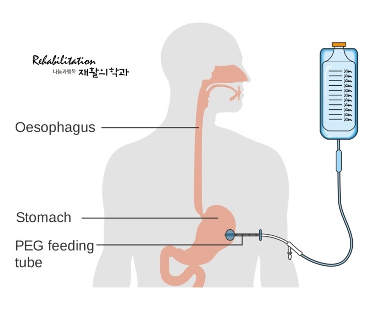뇌졸중환자의 콧줄과 뱃줄 - 비위관 vs 위루관 [삼킴검사를 통한 부산 연하 재활치료] : 네이버 블로그