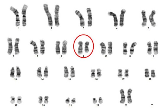 9번 염색체의 협동원체 역위 inv(9)(p11q13) : 네이버 블로그