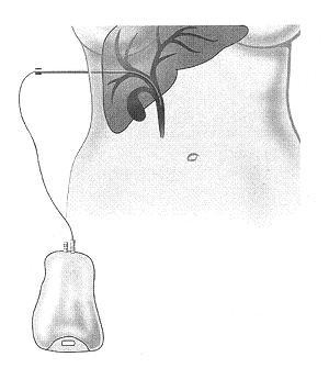 PTBD[Percutaneus transhepatic biliary drainage]경피경간담즙배액술, 폐색성 황달 감황 ...
