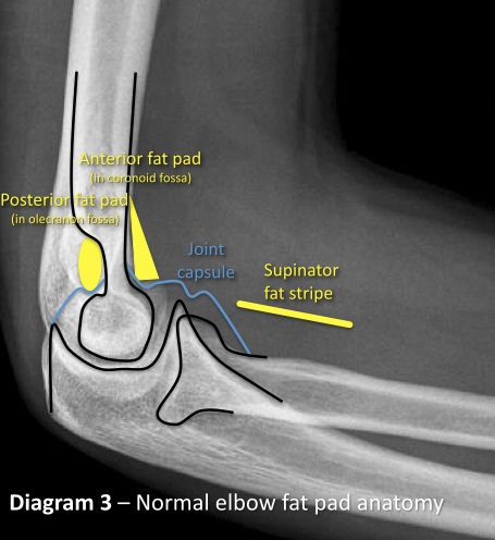 Elbow X-ray의 Fat pad sign : 네이버 블로그