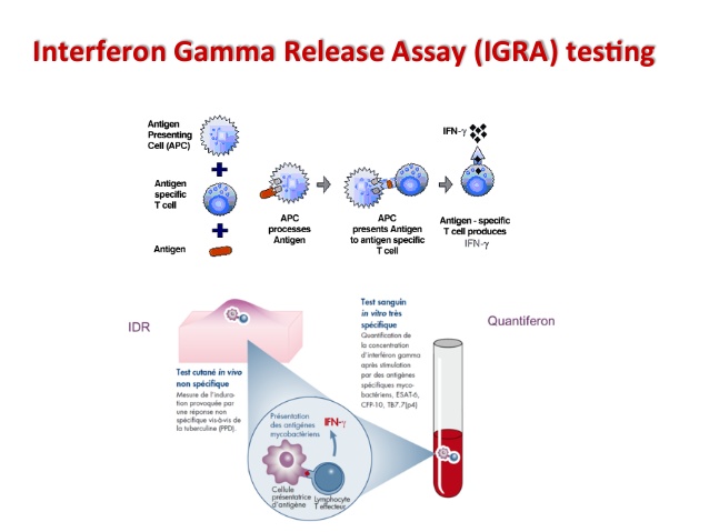 결핵검사 병원, 유학, 비자, 잠복결핵, IGRA, 결핵 스킨검사 : 네이버 블로그