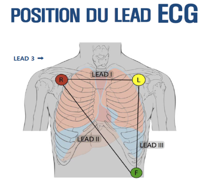 간호교육자료) EKG 심전도 ( 3 LEAD 모니터 ) : 네이버 블로그
